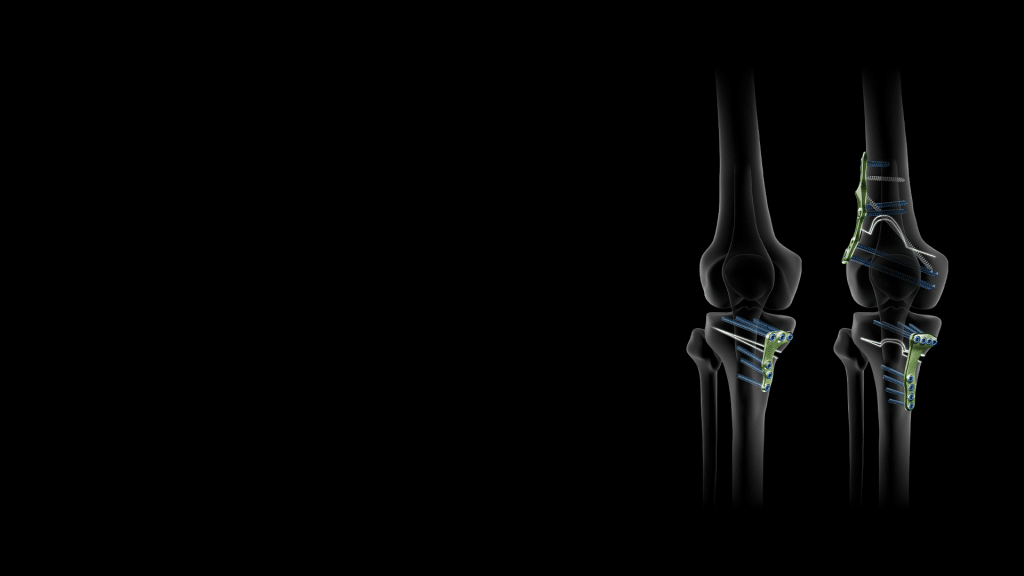 Documentation Lower Limb. - Newclip Technics