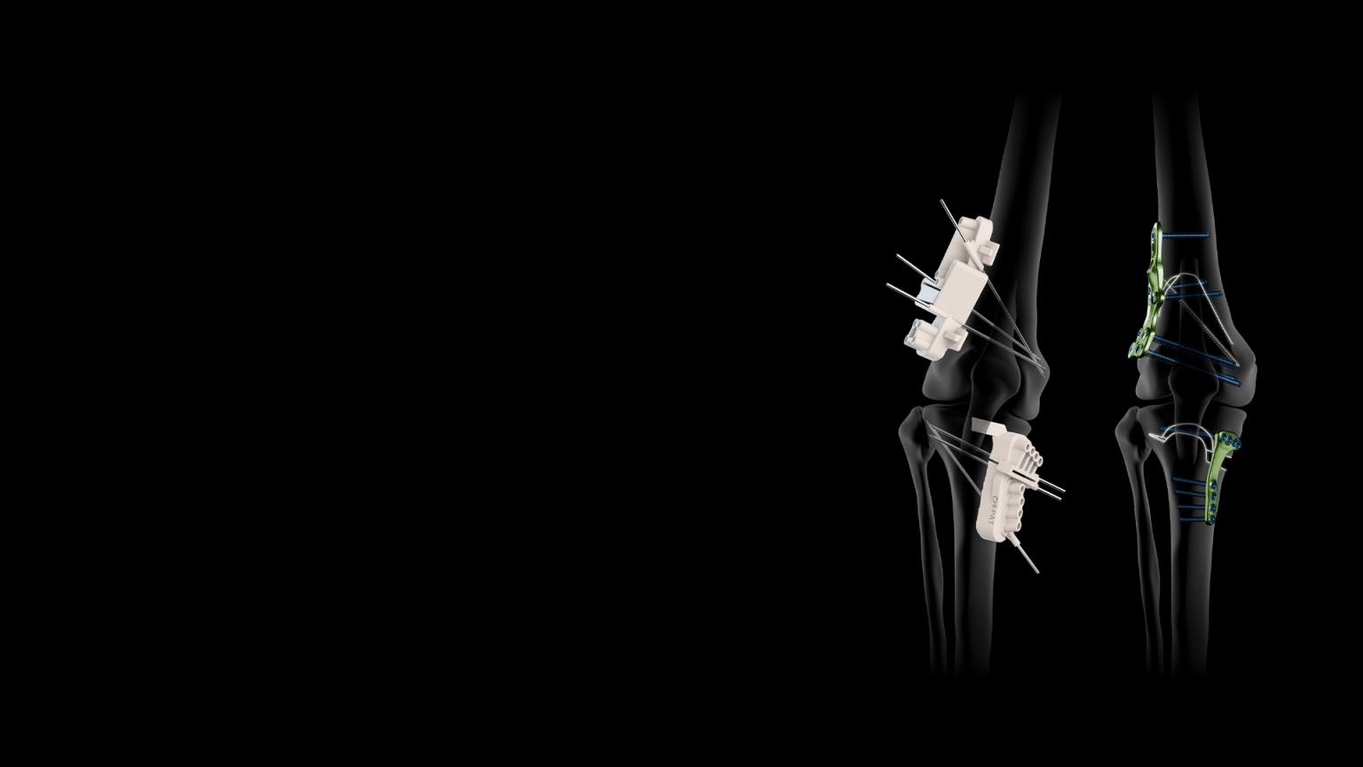 Lower Limb. - Newclip Technics