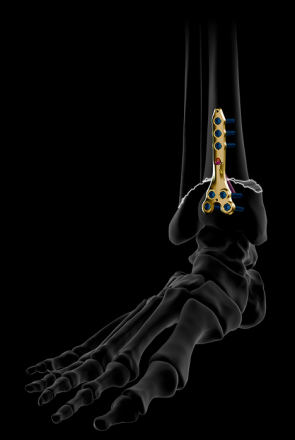 Activmotion S DTO - Osteotomy plates - Newclip Technics