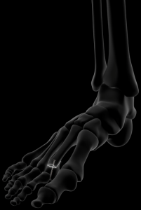 Footmotion Screws. - Kit pour l'avant pied - Newclip Technics