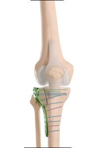 Lower Limb. - Newclip Technics