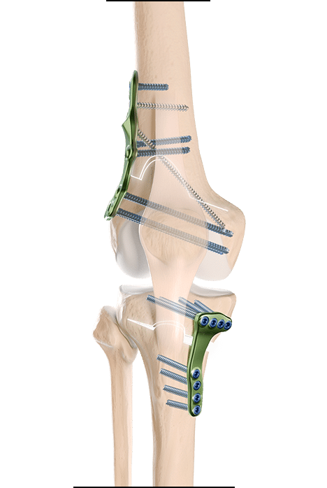 Lower Limb. - Newclip Technics
