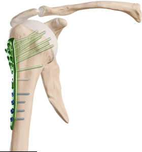 Upper Limb. - Newclip Technics